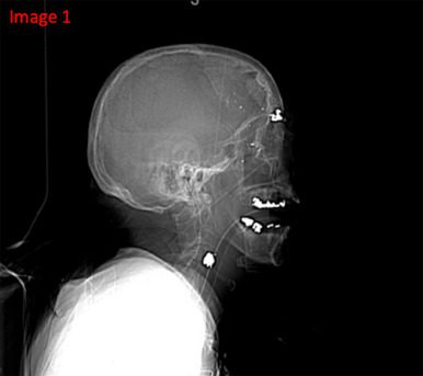 The Unpredictability of Ballistic Injuries - Boondocks Firearms ...